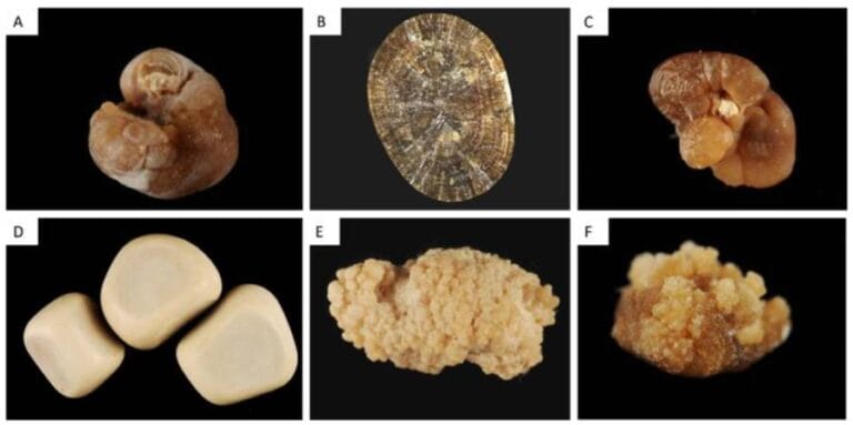سنگ کلیه و انواع آن ٬علت ایجاد و روش پیشگیری از هر کدام